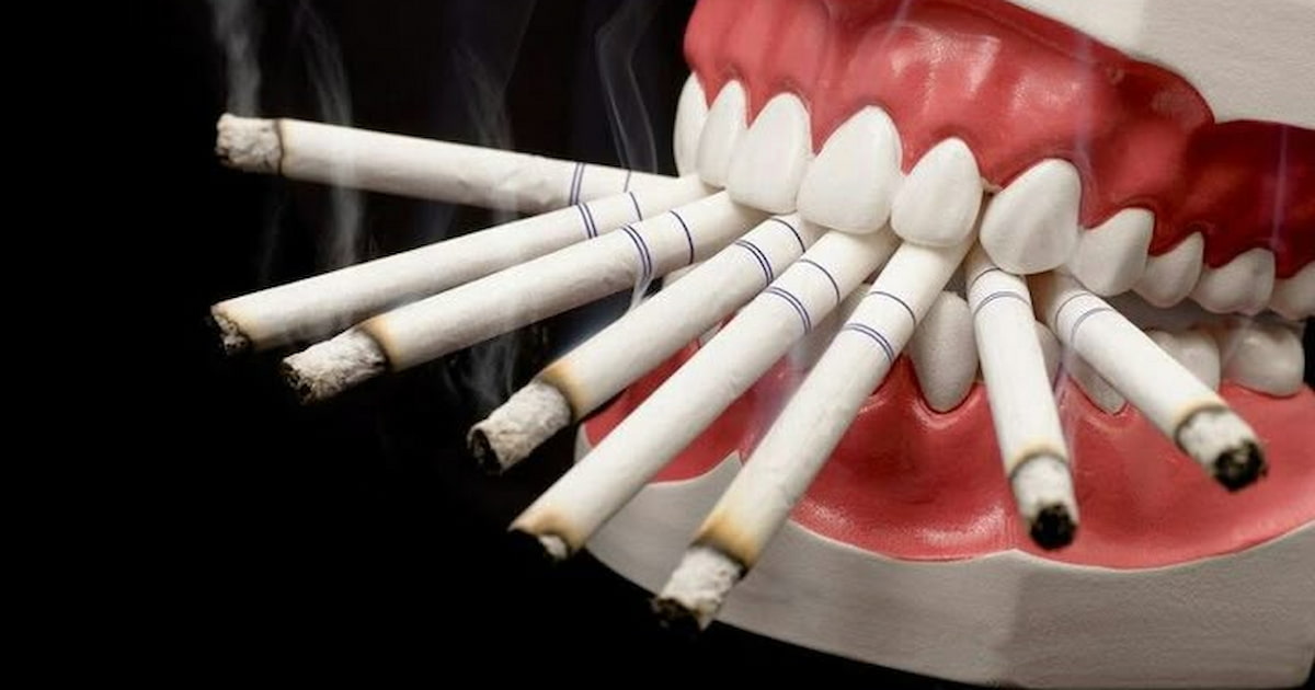 Smoking After Teeth Whitening: How It Impacts Your Results