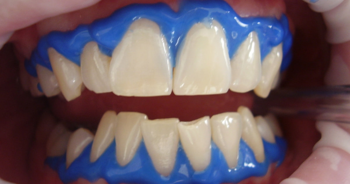 Best Teeth Whitening Product Canada – 2026 Buying Guide