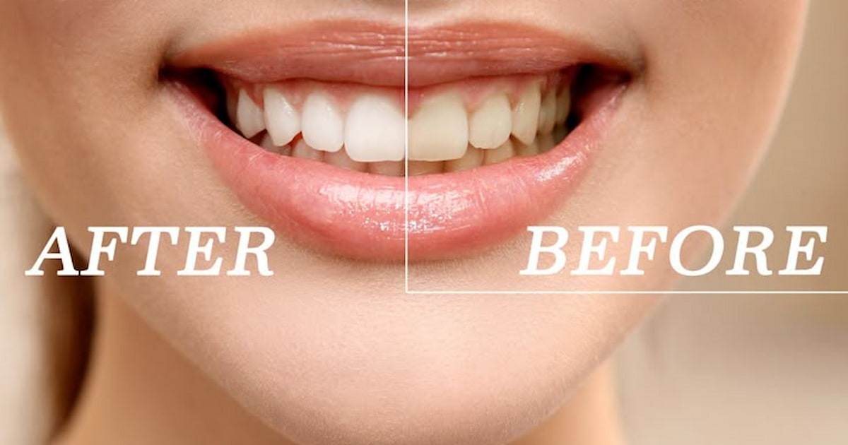 How Much Does Teeth Whitening Cost? Get the Full Breakdown