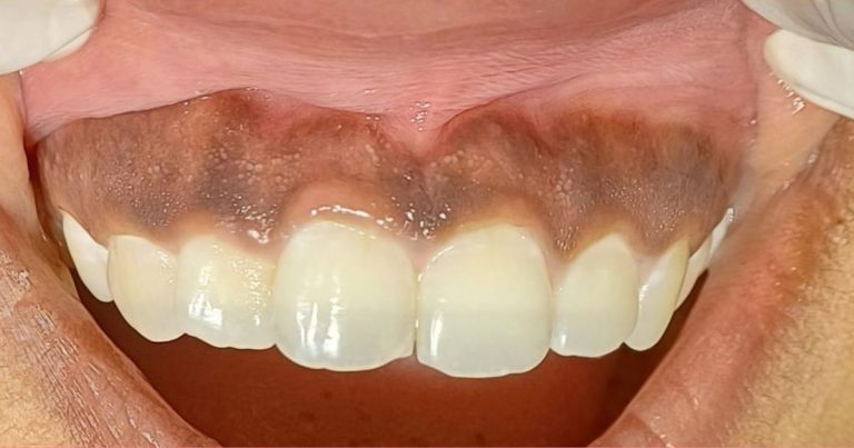 What Causes Black Gums? Symptoms, Causes, and Treatments Explained